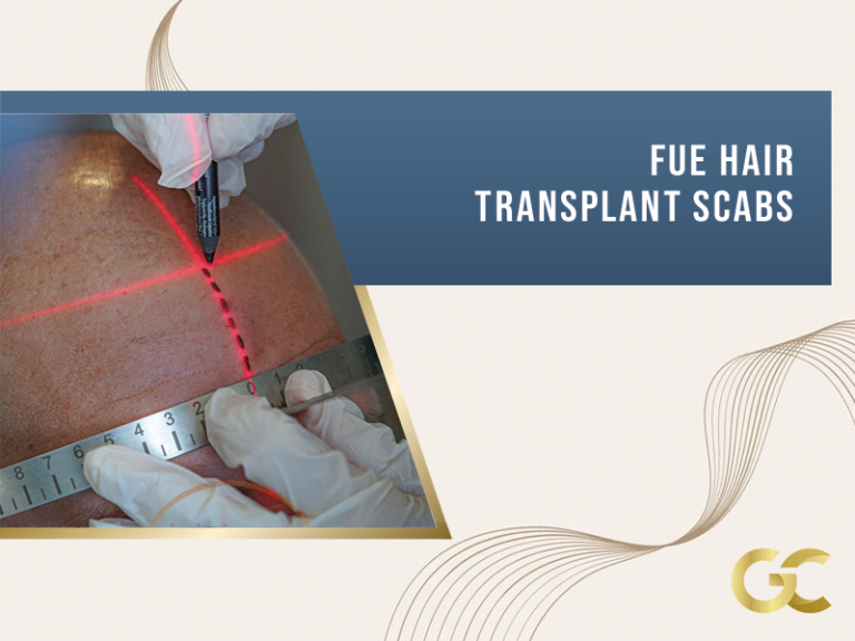 Fue Hair Transplant Scabs - Acıbadem Best Hair Transplant Turkey