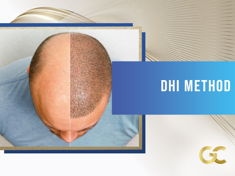 What is the DHI hair transplant method? - Acıbadem Best Hair Transplant ...