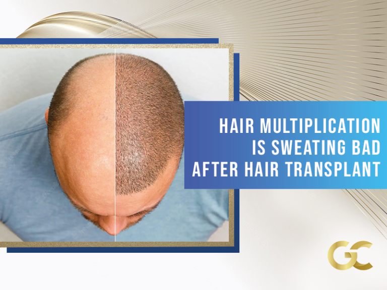 Hair Multiplication is sweating bad after hair transplant - Acıbadem ...